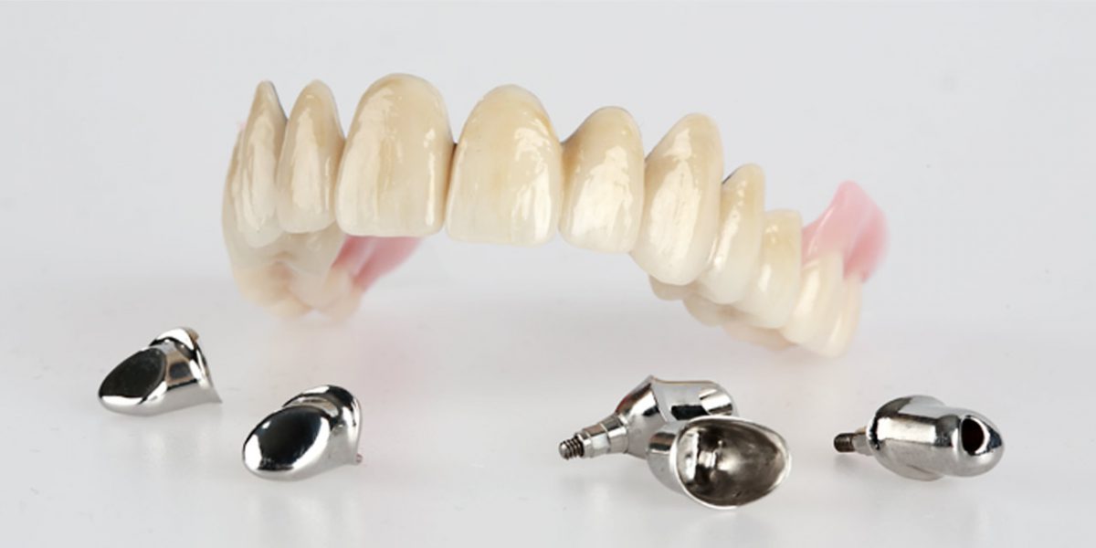 Kronen aus Nicht-Edelmetall – Dentallabor Feldmann