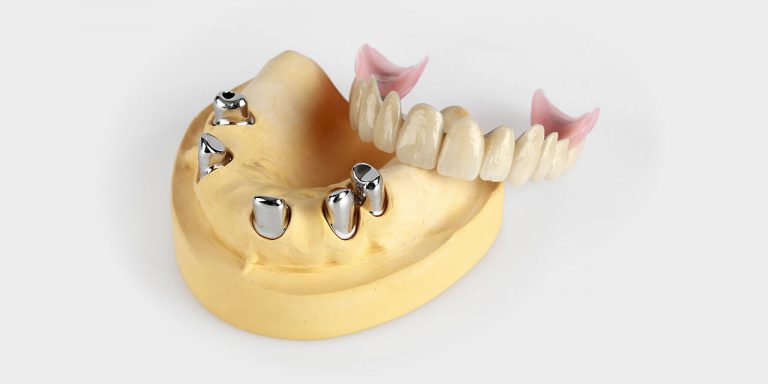 Totalprothese – Dentallabor Feldmann