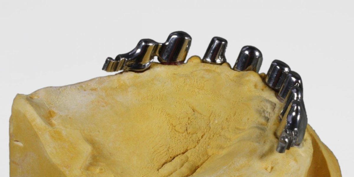 Zirkonkronen und -brücken – Dentallabor Feldmann