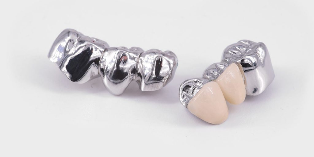 Kronen aus Nicht-Edelmetall – Dentallabor Feldmann